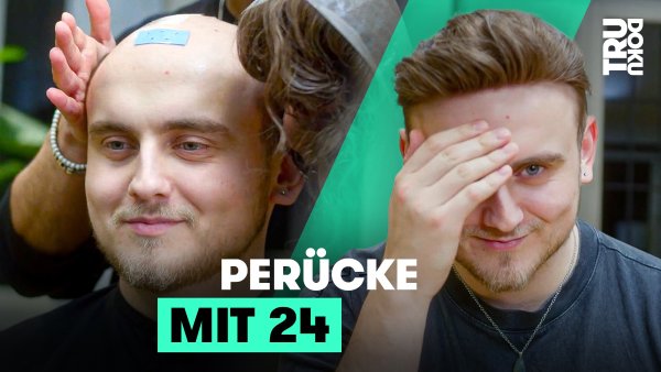 Kahler Kopf: Dennis fand sich hässlich | TRU DOKU